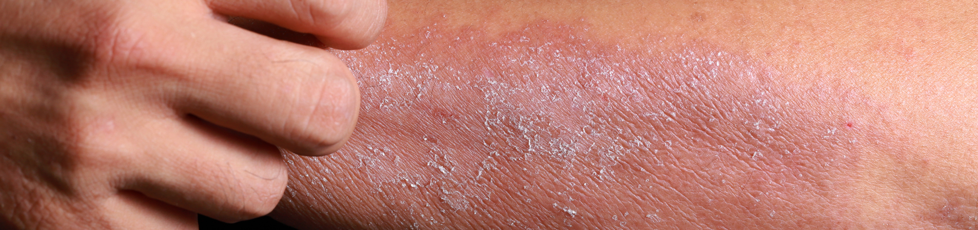 Topical Steroid Withdrawal – Bio-First