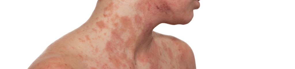 Caring For Radiation Dermatitis – Bio-First