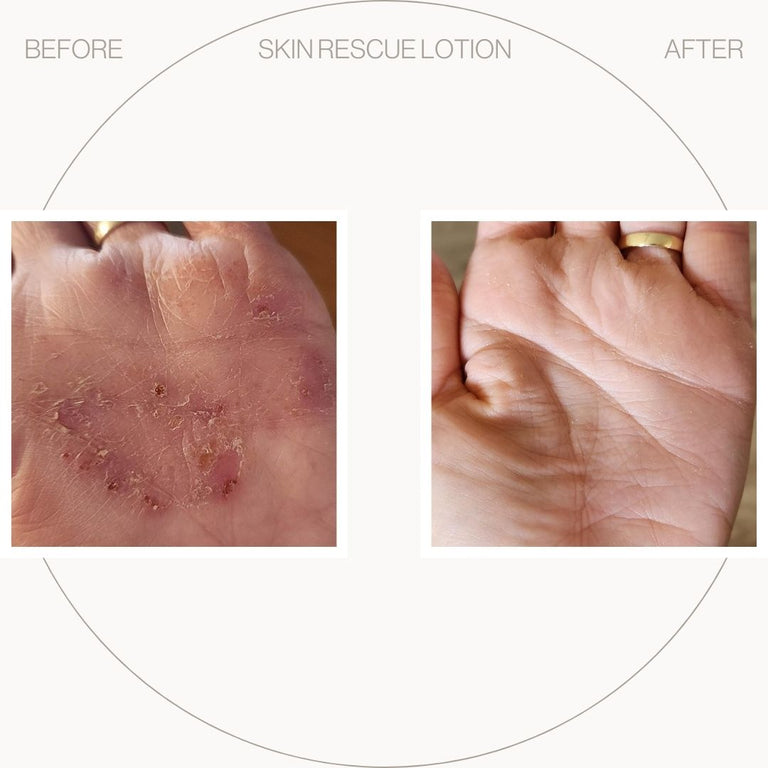 UltraSensitive Skin Rescue Lotion | Non-toxic Moisturiser For Sensitive ...